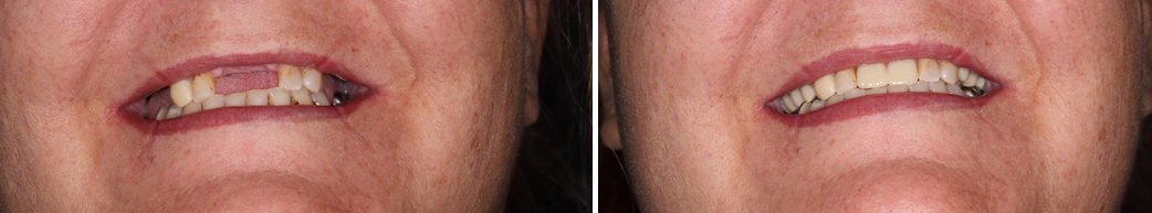 Replace Your Missing Teeth At-Home | ResetSmile